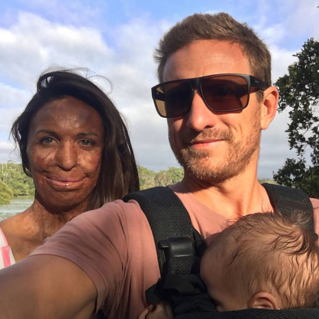 Turia Pitt shares photo of nose reconstruction